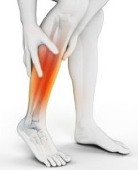 Stress Fractures v Shin Splints